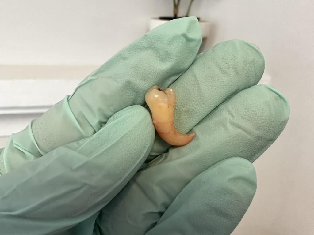 Prevent Bone Loss After Tooth Extraction | Dr Helen